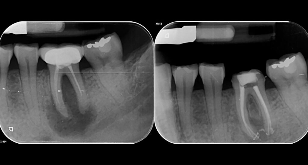 ENDODONCIA – Clínica Dental Raquel Colón